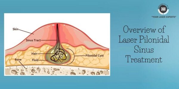 An Overview of Laser Treatment of Pilonidal Sinus-Things You Must Know ...