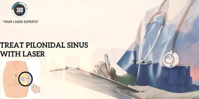 How to Treat Pilonidal Sinus with Laser Operation? – Laser360clinic.com